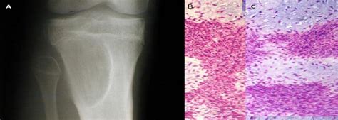 Radiograph Of The Proximal Tibia Reveals A Large Lucent Slightly Download Scientific Diagram