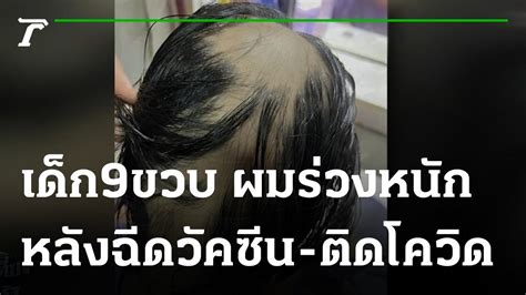 เด็ก 9 ขวบ ผมร่วงหนักหลังฉีดวัคซีน 31 08 65 ข่าวเที่ยงไทยรัฐ Youtube