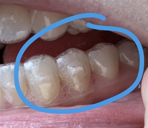 Is This Too Much Space Rinvisalign