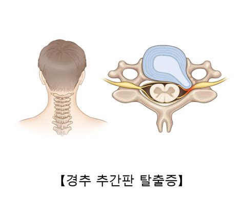 경추 추간판 탈출증 질환백과 의료정보 건강정보 서울아산병원