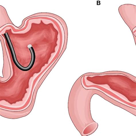 Gastric Fundus Subdivisions A Fornix B Lesser Curvature Of The