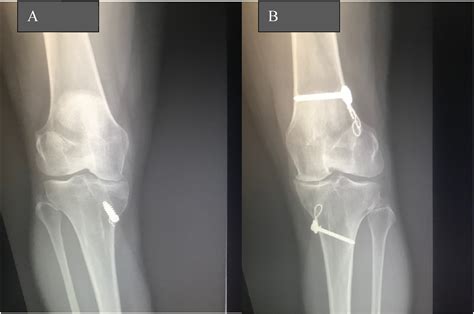 Effects Of Pilates On Reconstructed Knee With Oa Pilates Alliance