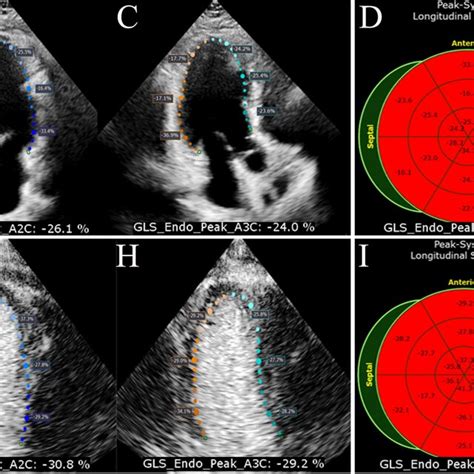 The Measurement Of Lv Gls By Autostrain A E2d Ste F Jcecho Ste