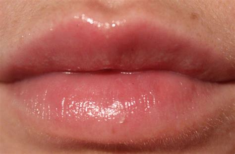 Белые точки на губах: причины появления, опасность и способы избавления