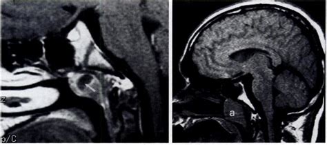 Adenoidal Hypertrophy A Sagittal Gadolinium Enhanced Image Of A