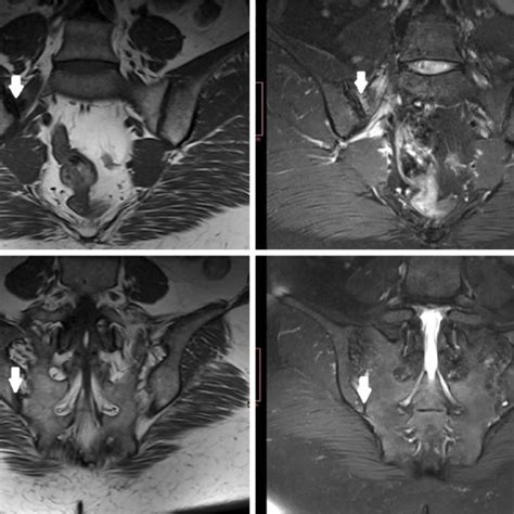 Sacroiliac Magnetic Resonance Imaging Showing Active Sacroiliitis