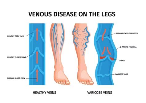Understanding Varicose Veins Causes Symptoms And Treatment Options