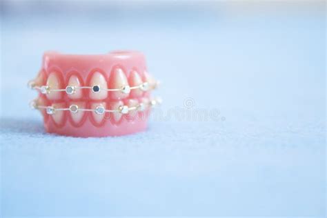 Metal Orthodontic Denture Base Stock Image Image Of Orthodontist