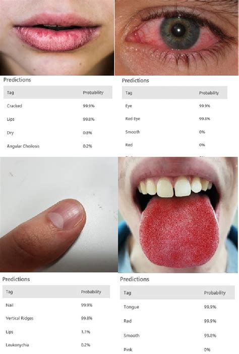 Vitamin Deficiency Detection Using Image Processing And Neural Network Semantic Scholar