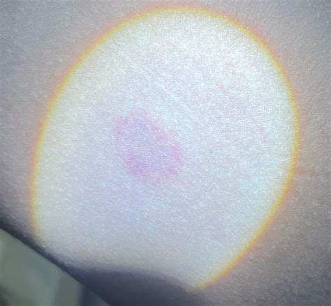 Ringworm Or Something Else R Dermatologyquestions