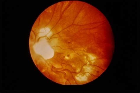 Toxocara Retina Image Bank