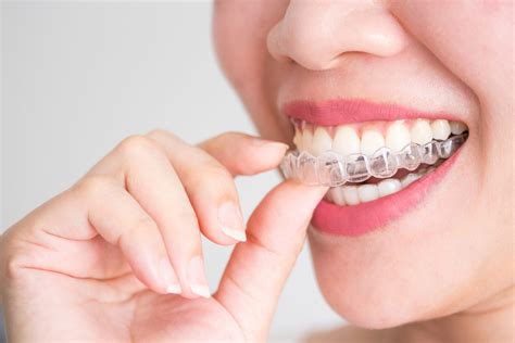 ClearCorrect An Alternative To Braces Herbert S Birnbaum DMD