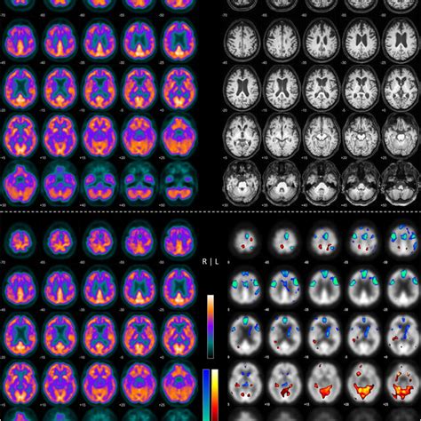 Top Percentage Of Intra And Between Reader Discrepant Cases In The