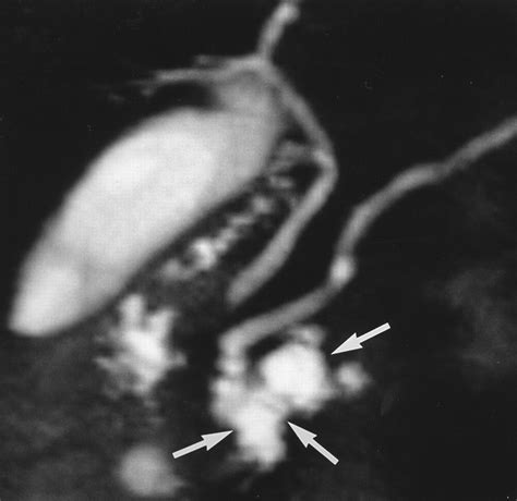MR Cholangiopancreatographic Differentiation of Benign and Malignant ...