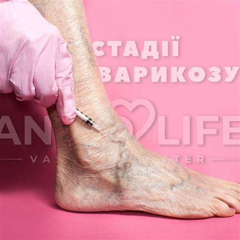 Стадии варикоза фото