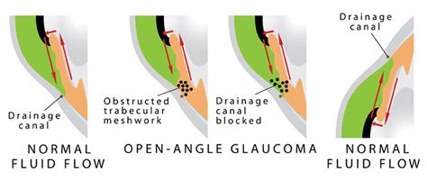 Open Angle Vs Closed Angle Glaucoma Glaucoma East Syracuse And New