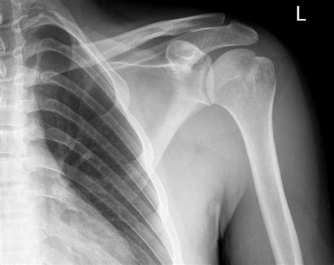Shoulder Dislocation 1 Buyxraysonline