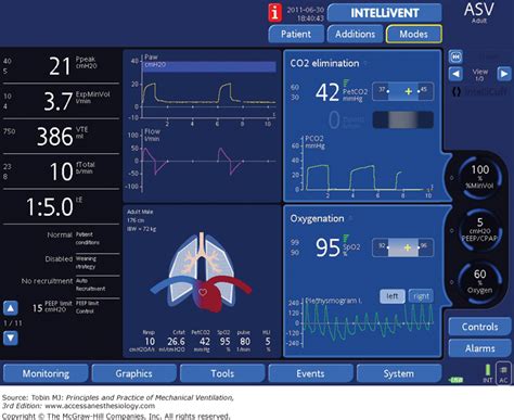 Chapter 3 Basic Principles Of Ventilator Design Principles And