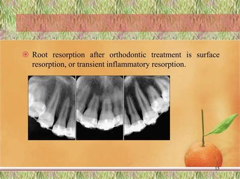 Root Resorption In Orthodontics Ppt Bone And Joint Conditions