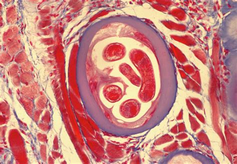 Trichinella Spiralis
