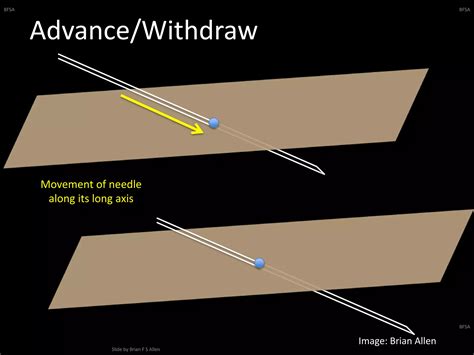 Needle Probe Movement For Regional Anesthesia Pptx