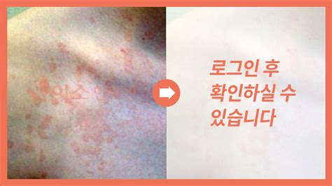 지루성 피부염 20대 남성 이소한의원