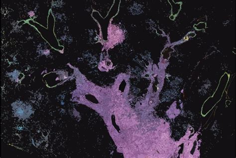 How Lung Cancer Can Transform Into Another Type • Healthcare In