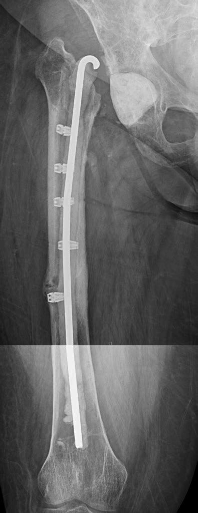 Bilateral Tha Revision For Severe Varus Remodeling Darwin Chen Md