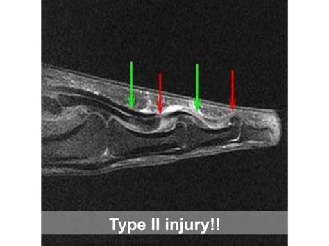 Tendon Injuries Of Hand Pptx