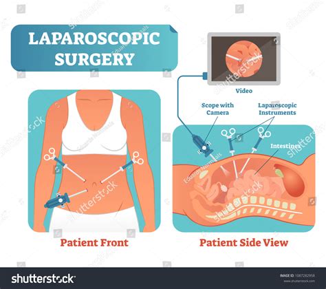623 Laparoscopic Surgery Illustration Images Stock Photos Vectors Shutterstock