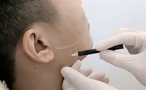 All You Need To Know About Masseter Jaw Botox And Its Effectiveness