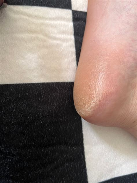 발 뒤꿈치 각질 원인부터 완벽 제거까지 찐후기 네이버 블로그