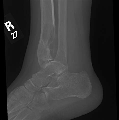 Radiopaedia Case Giant Cell Tumor Distal Tibia Id 16266 Study