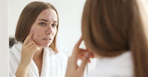 What Is Acne Conglobata The Severe Condition Is Rarely Discussed