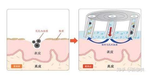 小气泡是什么？任何人都能做吗？ 知乎