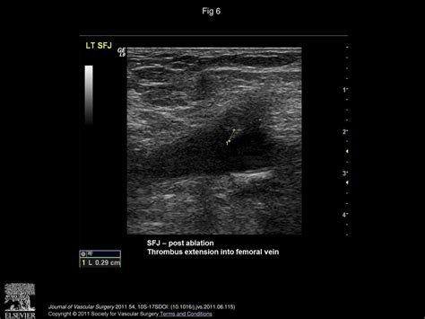 Great Saphenous Vein Patency And Endovenous Heat Induced Thrombosis