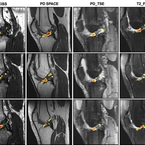 Representative Central Slice View Of The Occlusion Maps Superimposed On