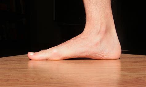 Posterior Tibialis Tendon Dysfunction Diagnosis And Treatment