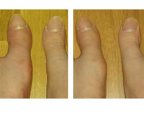 After Wearing Split For Several Months Immediately After Taking Off And After A Night Wout It