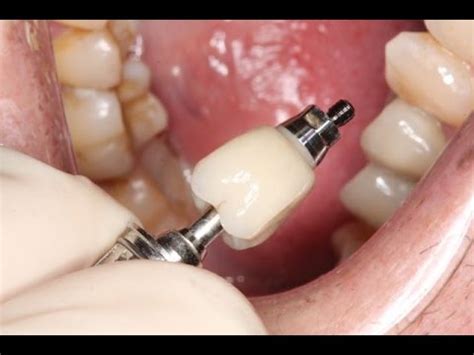 Full Contour Zirconia Implant Crown Insert YouTube