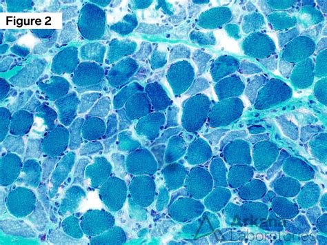 Critical Illness Myopathy Neuro Notes Arkana Laboratories
