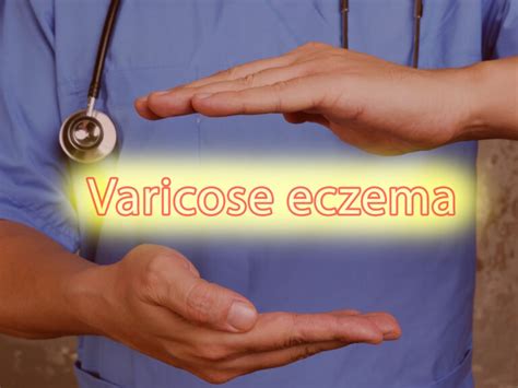 Varicose Eczema How Serious Is It Grand Junction Vein Center
