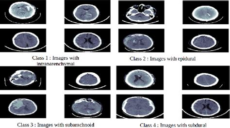 Figure 1 From Intracranial Hemorrhage Detection Using Neural Network