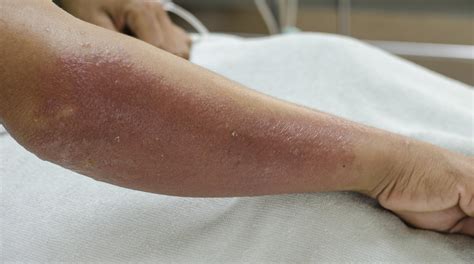 Severe Eczema Signs Severe Eczema