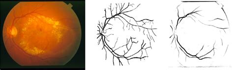 Retinal Vessel Segmentation Using Resnet Unet A Actual Image B