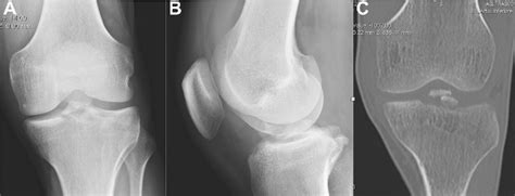Figure 1 From Arthroscopic Absorbable Suture Fixation For Tibial Spine Fractures Semantic Scholar