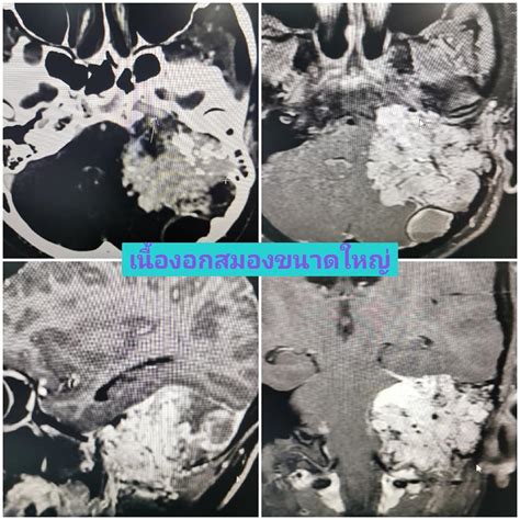 การผ่าตัดเนื้องอกสมอง Brain Tumor ที่มีขนาดใหญ่ และมีหลอดเลือดมา
