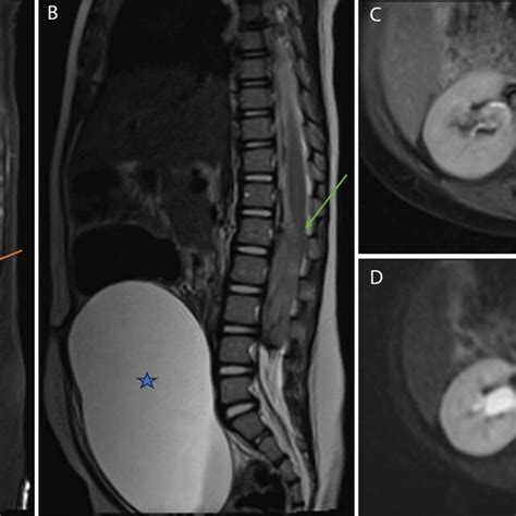 Pre Operative Mri Of The Spine Sagittal T1 Post Gadolinium Contrast