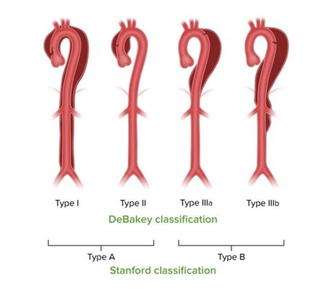 Carotid Artery Stenosisaortic Dissectionbuerger Disease Flashcards