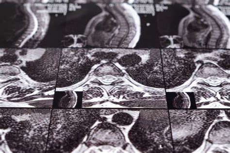 Mri Of A Patient With Intervertebral Disc Protrusion And